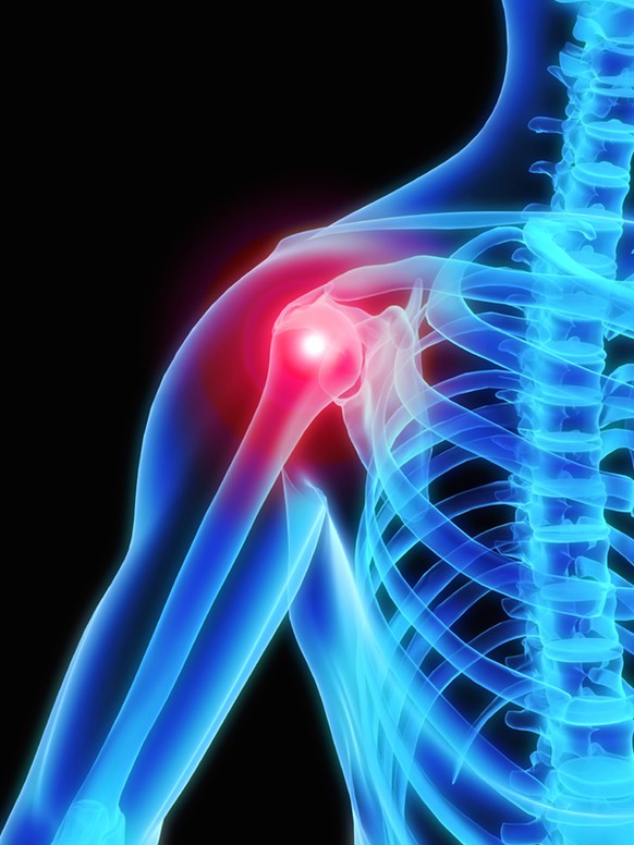 Shoulder Impingement Syndrome and Shoulder Pain | Regenerative Medicine ...